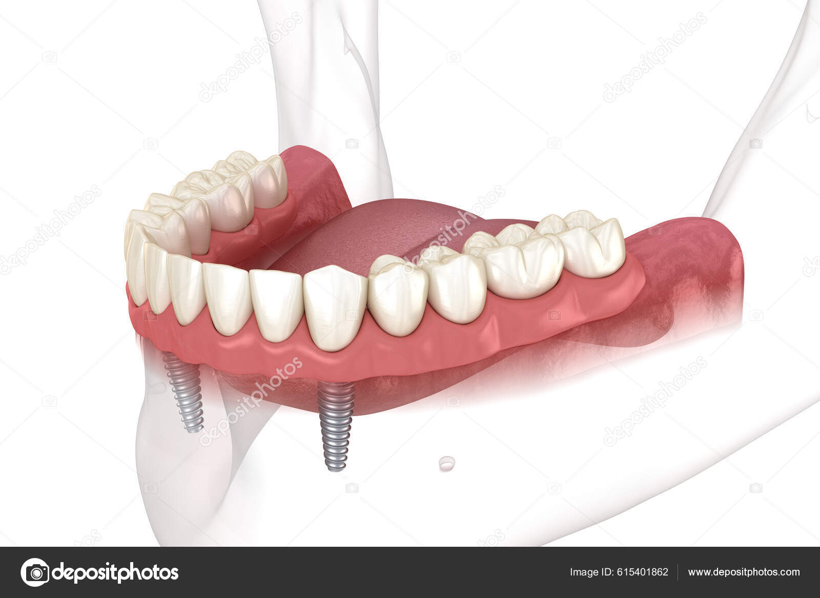 Mandibular Removable Prosthesis All System Supported Implants Ball ...