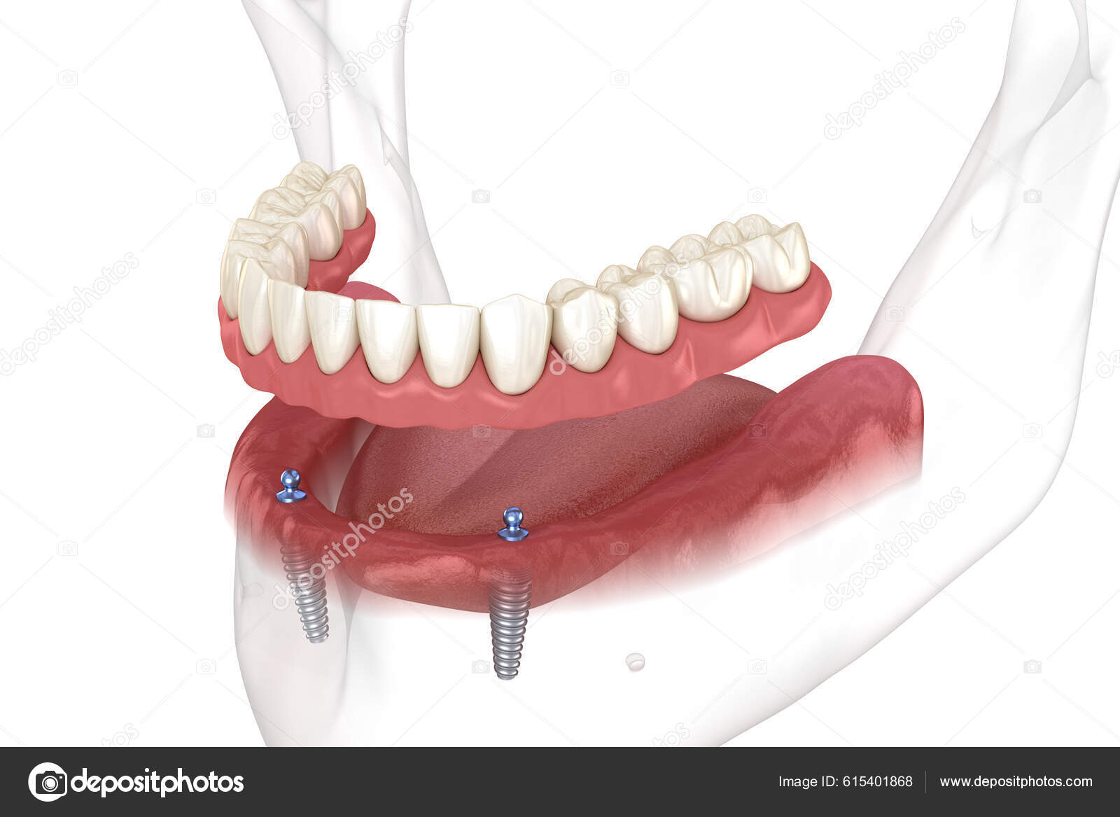 Mandibular Removable Prosthesis All System Supported Implants Ball ...