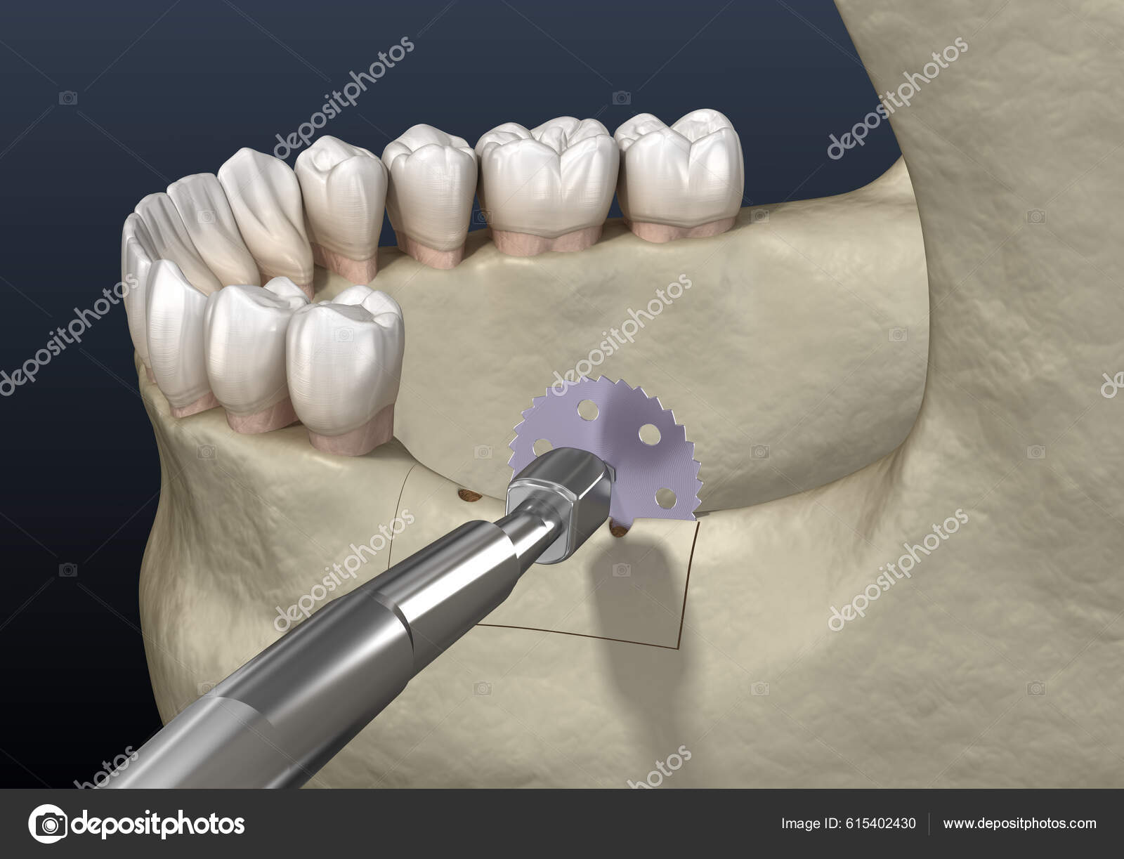 Cleavage Alveolar Ridge Augmentation Dental Surgery Illustration ...