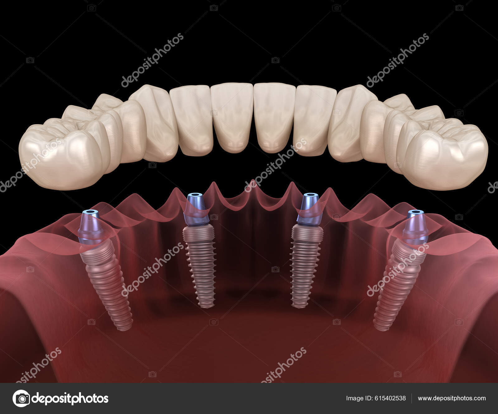 Mandibular Prosthesis All System Supported Implants Medically Accurate ...