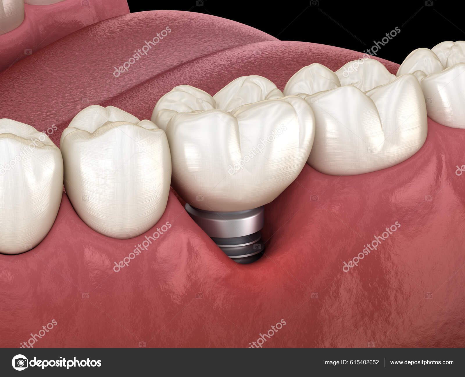 Peri Implantitis Visible Gum Recession Medically Accurate Illustration ...