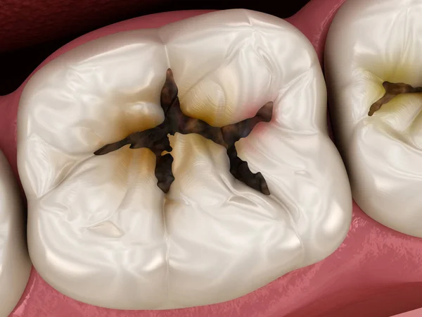 Molar Tooth Damaged Caries Medically Accurate Tooth Illustration ...