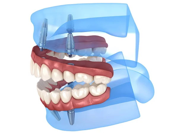 Maxillary Mandibular Prosthesis Gum All System Supported Implants ...