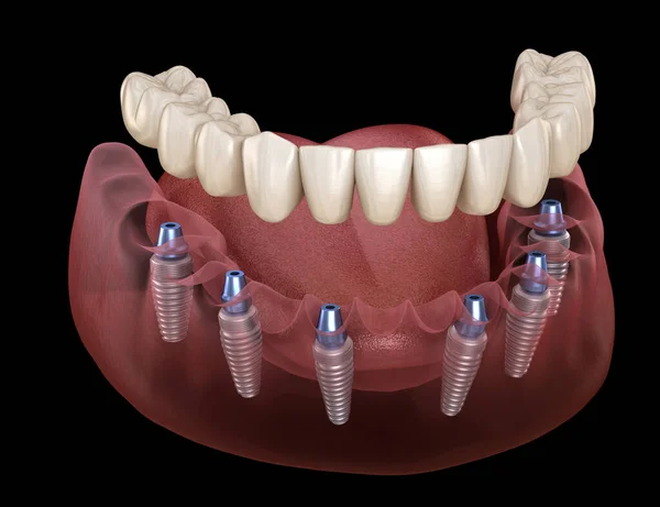 Mandibular Prosthesis All System Supported Implants Medically Accurate ...
