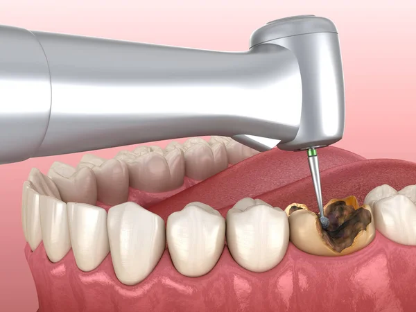 Removing Caries Medically Accurate Tooth Illustration Stock Photo by ...