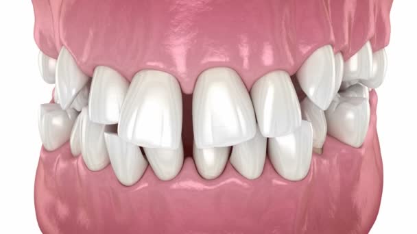 Abnormal Teeth Position Correction Process Medically Accurate Dental ...