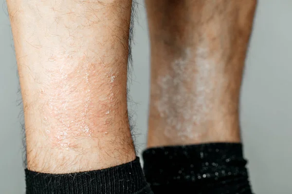 La psoriasis aguda na es una enfermedad dermatológica incurable ...