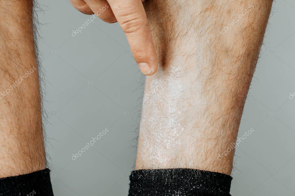 La psoriasis aguda na es una enfermedad dermatológica incurable ...