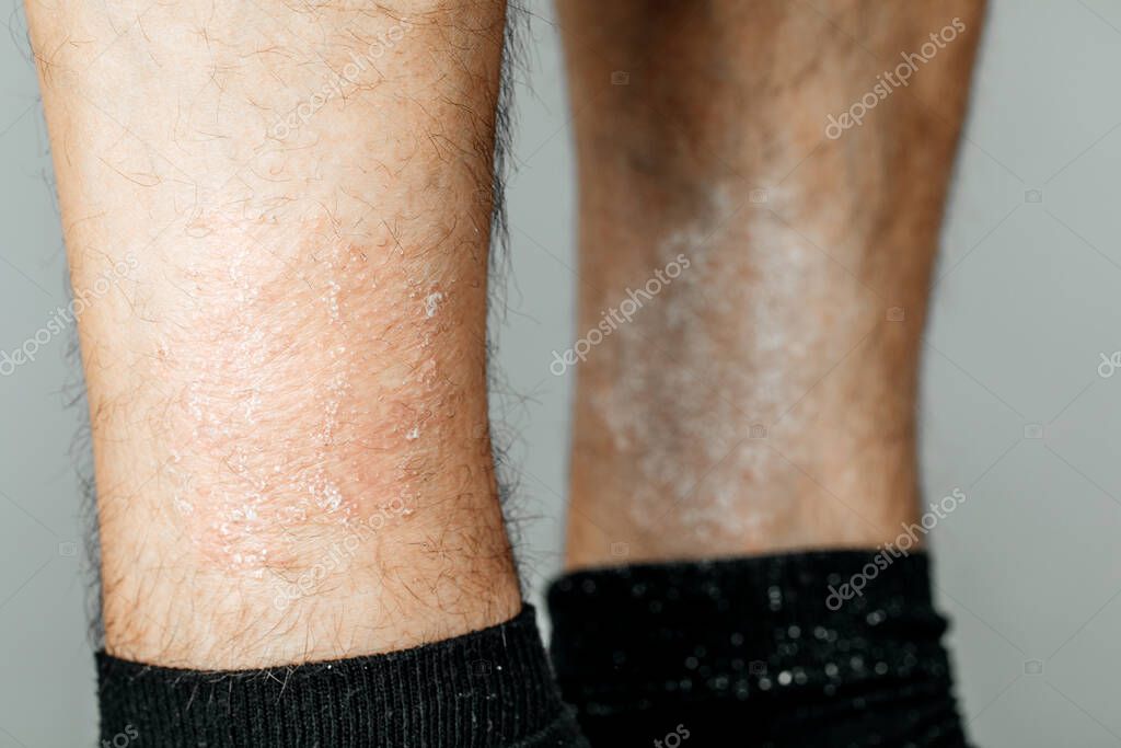 La psoriasis aguda na es una enfermedad dermatológica incurable ...