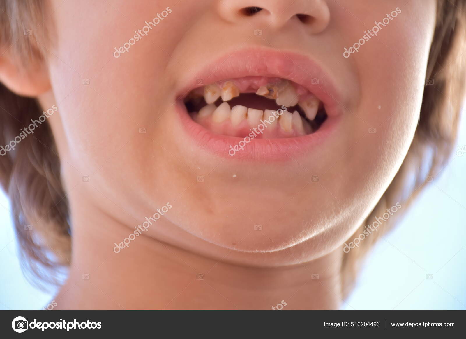 Bad Teeth Child Caries Stock Photo by ©GalinkaLB 516204496