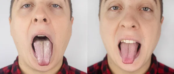 Antes y después. Cuajada blanca en la lengua. Un médico o ...