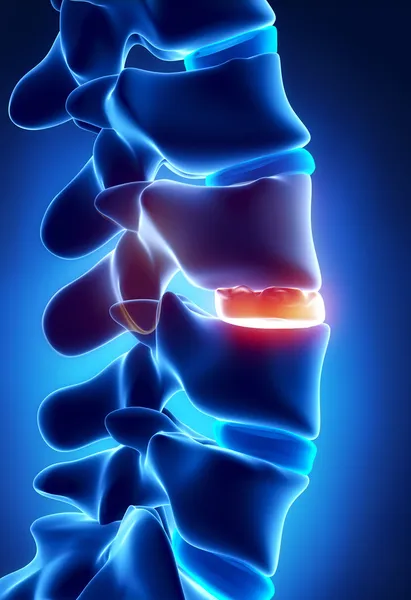 Bulging disc Stock Photos, Royalty Free Bulging disc Images | Depositphotos