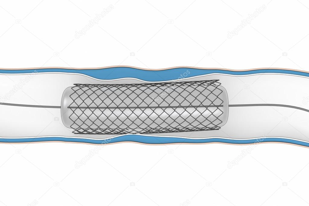 El balón del stent abre la arteria 2023