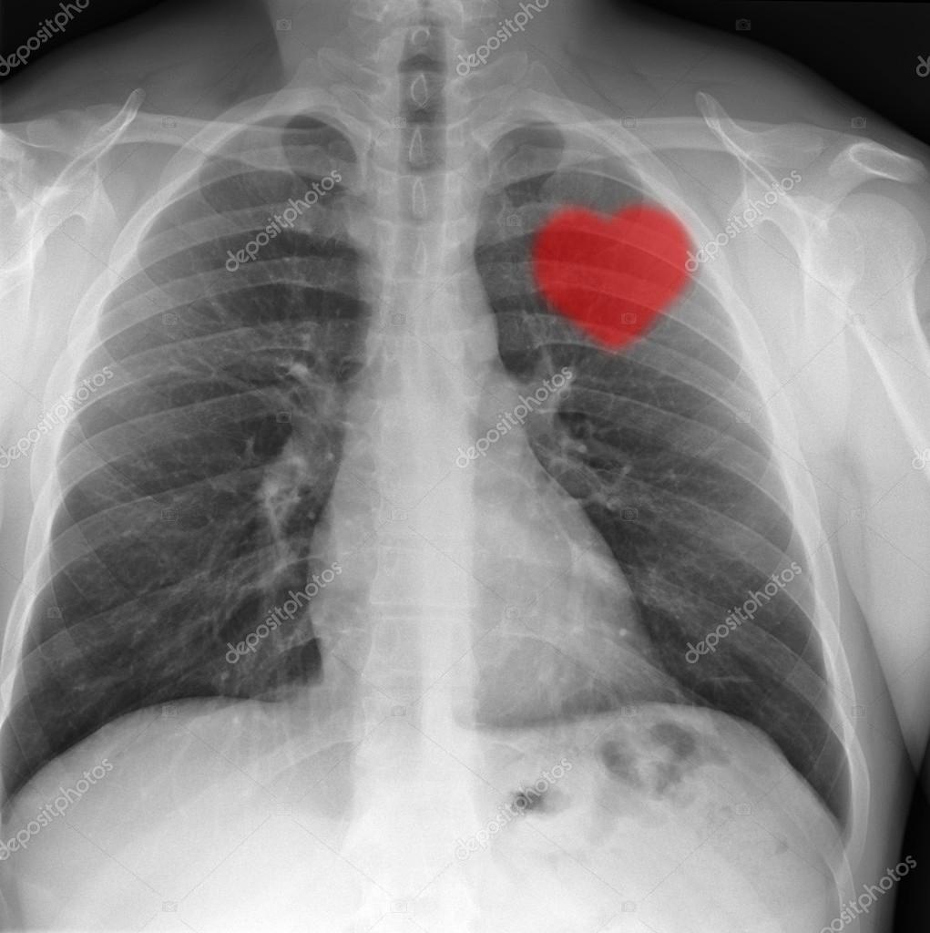 Xray Image Of Human Chest Highres Stock Photo Getty Images