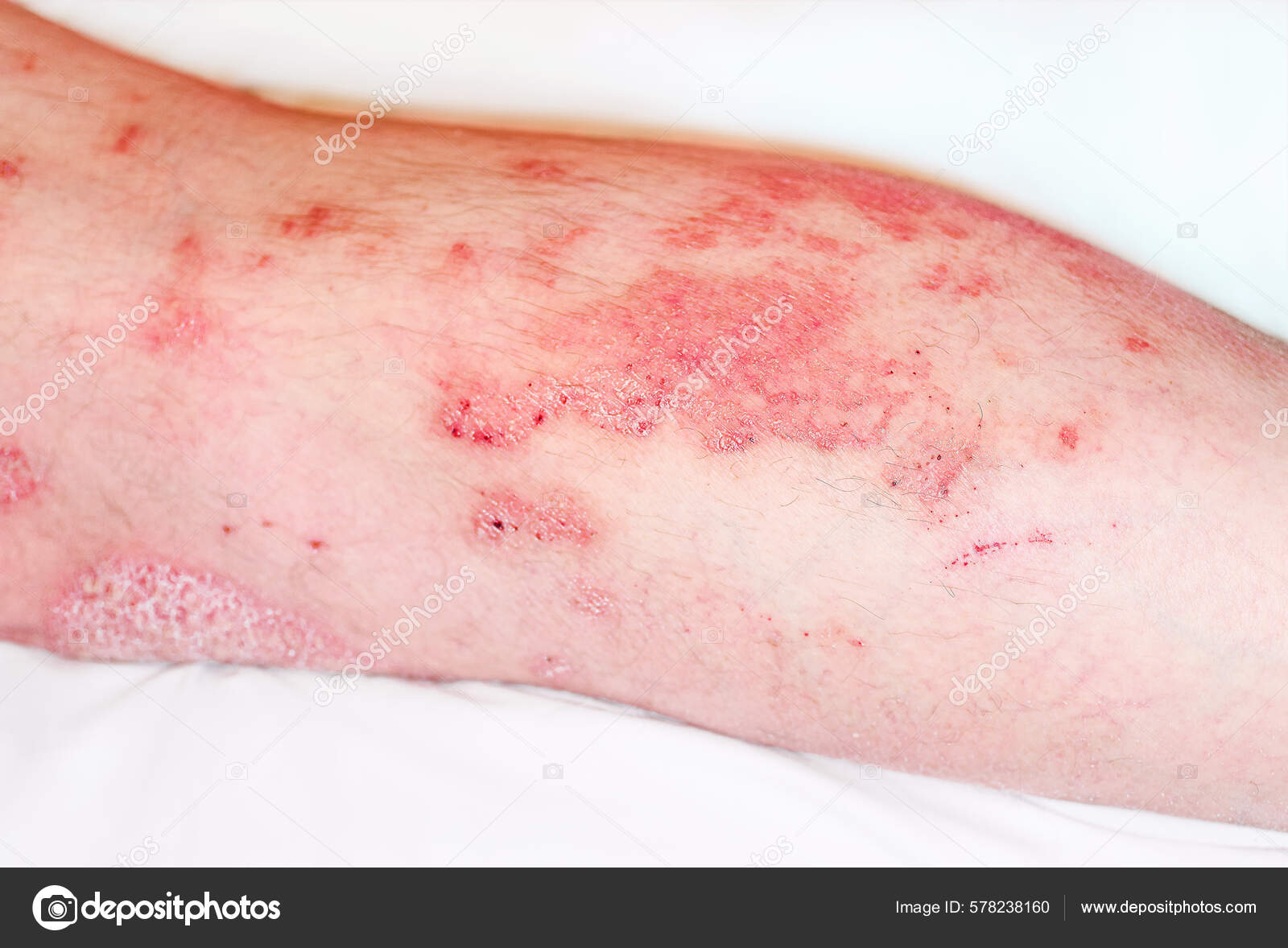Psoriasis Aigu Rougeur Sévère Peau Une Maladie Cutanée Dermatologique ...