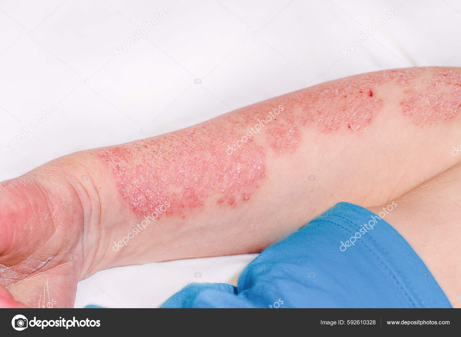 Psoriasis Arm