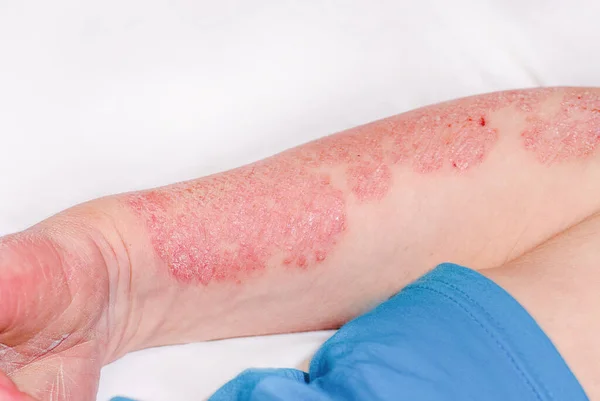 Streptocoques images libres de droit, photos de Streptocoques ...