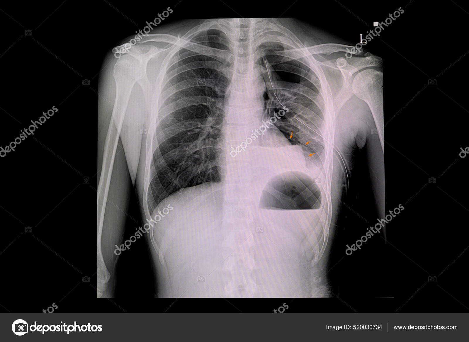 Xray Chest Patient Left Icd Moderate Amount Left Hydro Pneumothorax ...