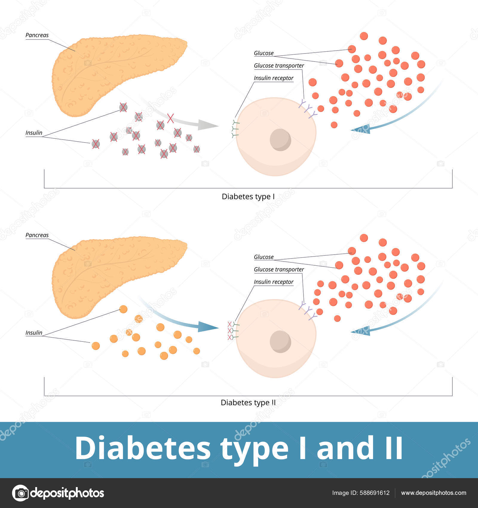 Diagrama De Diabetes Tipo 1 Pancreas Diabetes Tipo 1 Y 2