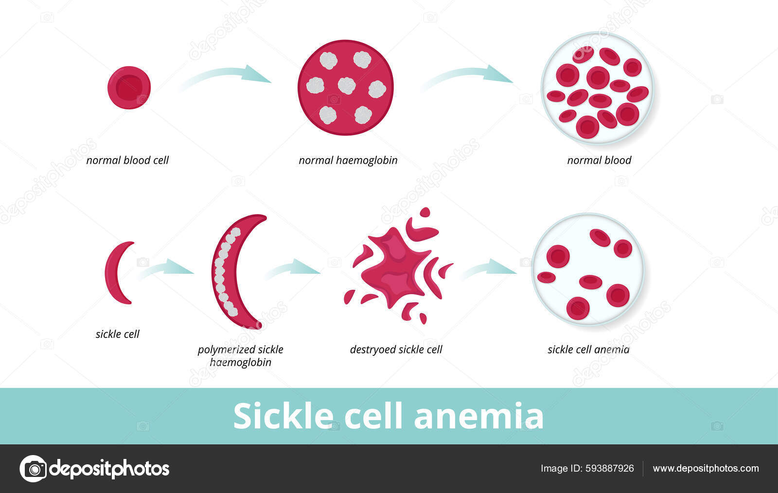 Sickle Cell Anemia Sickle Cell Anemia Disease Occurs Due Sticky Vektor ...