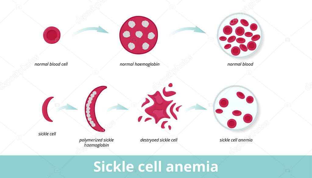 Sickle Cell Anemia Sickle Cell Anemia Disease Occurs Due Sticky Vector ...