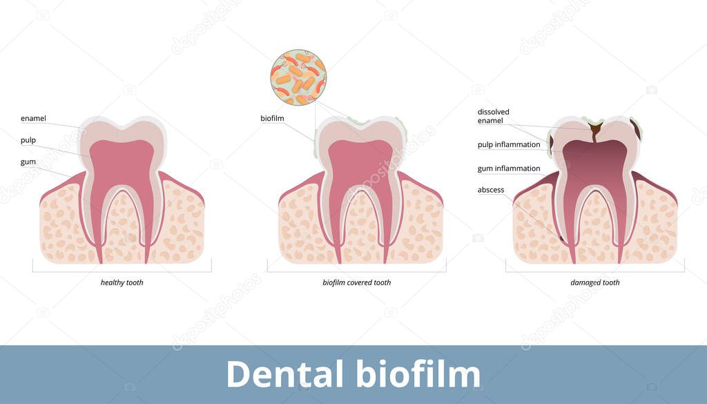 Biofilm dental. La biopelícula cubre los dientes y causa la desolvación ...