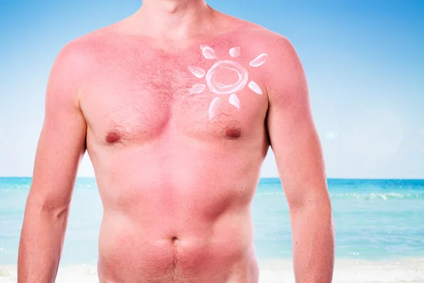 Man with a sunburn Stock Photo by ©rsedlacek 30110289