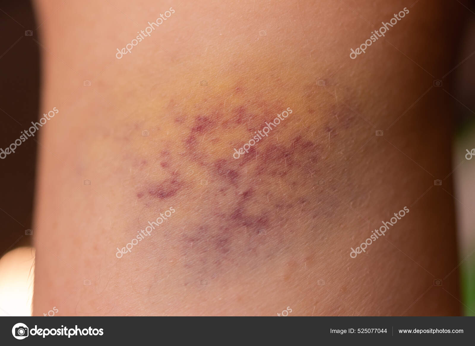 Closeup Bruise on wounded womans leg skin. — Stock Photo © vershinin ...