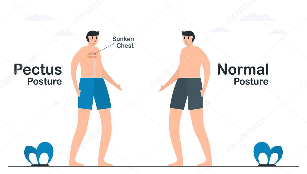 Comparación de la postura normal y del pectus. El pectus excavatum tiene el pecho hundido ...