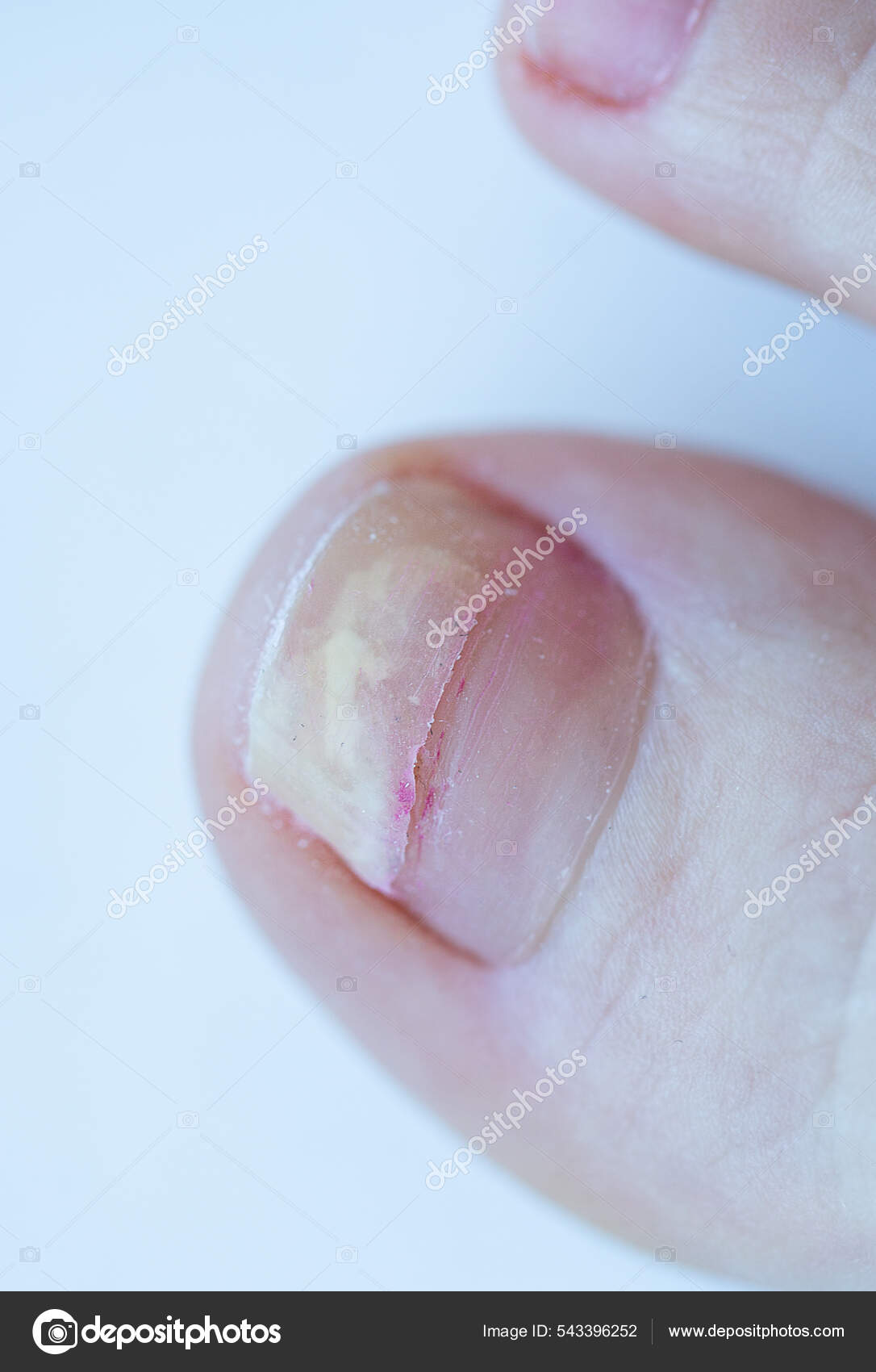 Fracture Detachment Nail Big Toe Nail Disease Crack Gap Close — Stock ...