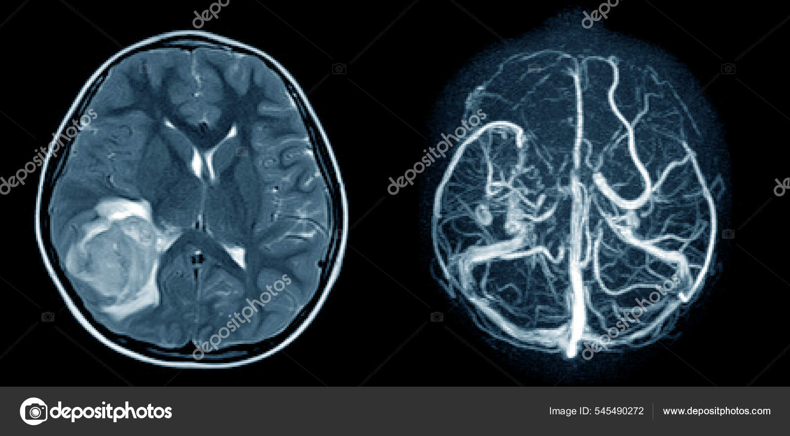 Magnetic Resonance Imaging Brain Mra Mrv Brain Impression Large Acute ...