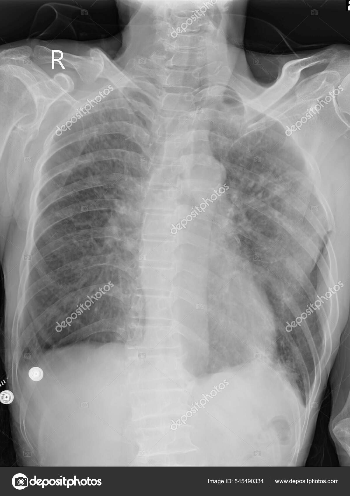 Chest X Ray Infiltrates