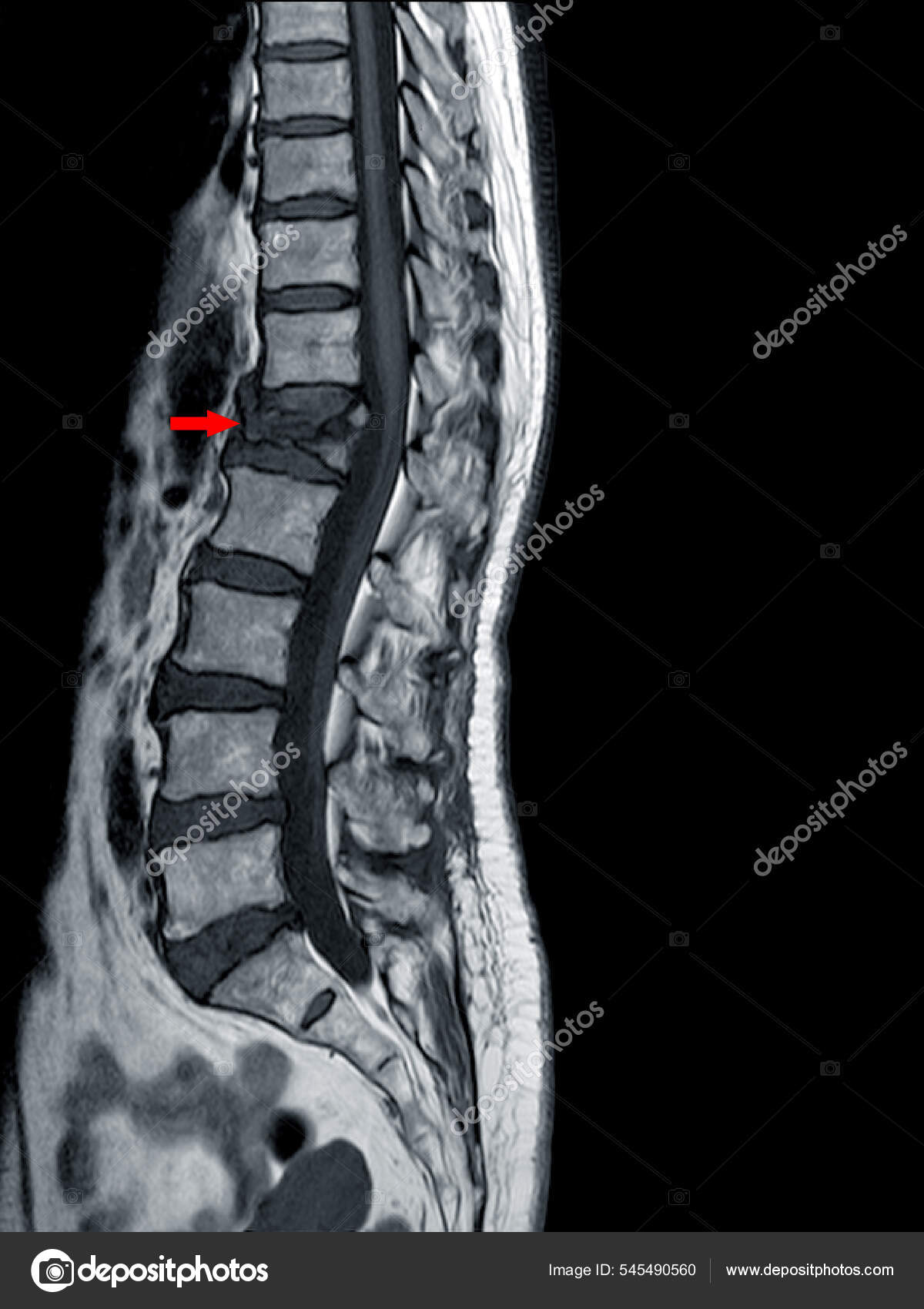 Mri Thoracolumbar Spine Moderate Severe Compression Fracture Vertebra ...