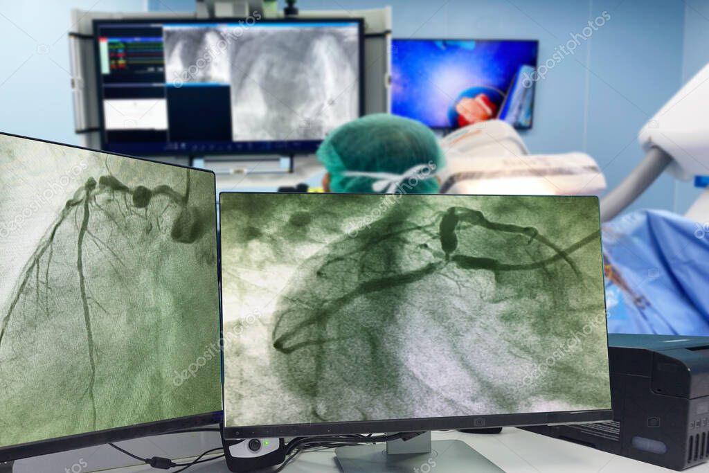 Angiografía coronaria (CAG) en monitor LCD y borrosa del moderno Cath ...