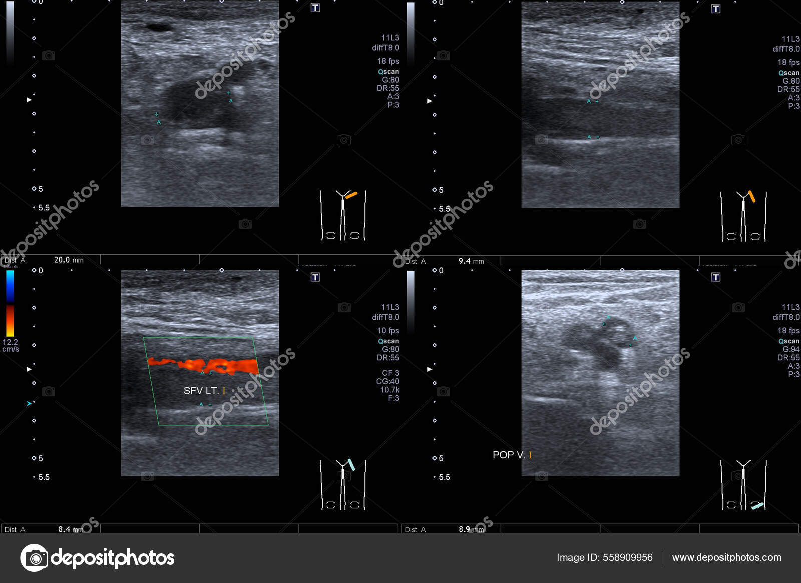 Ecografía Doppler Trombosis Venosa Profunda Vena Femoral Superficial ...