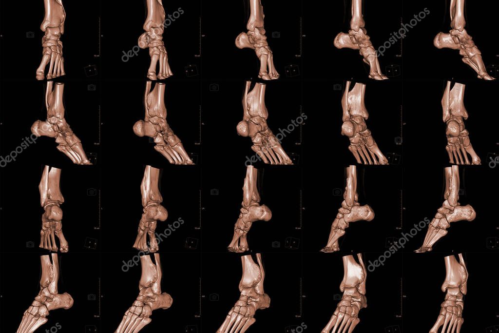 Close up ankle x ray 3d distal tibia anatomy. 2022
