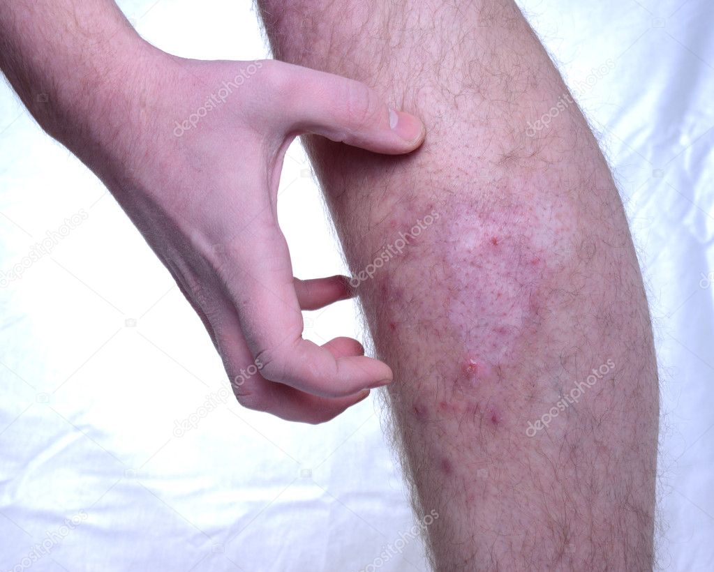 Descargar - Picazón en la piel. Pigmento que falta en la piel ...