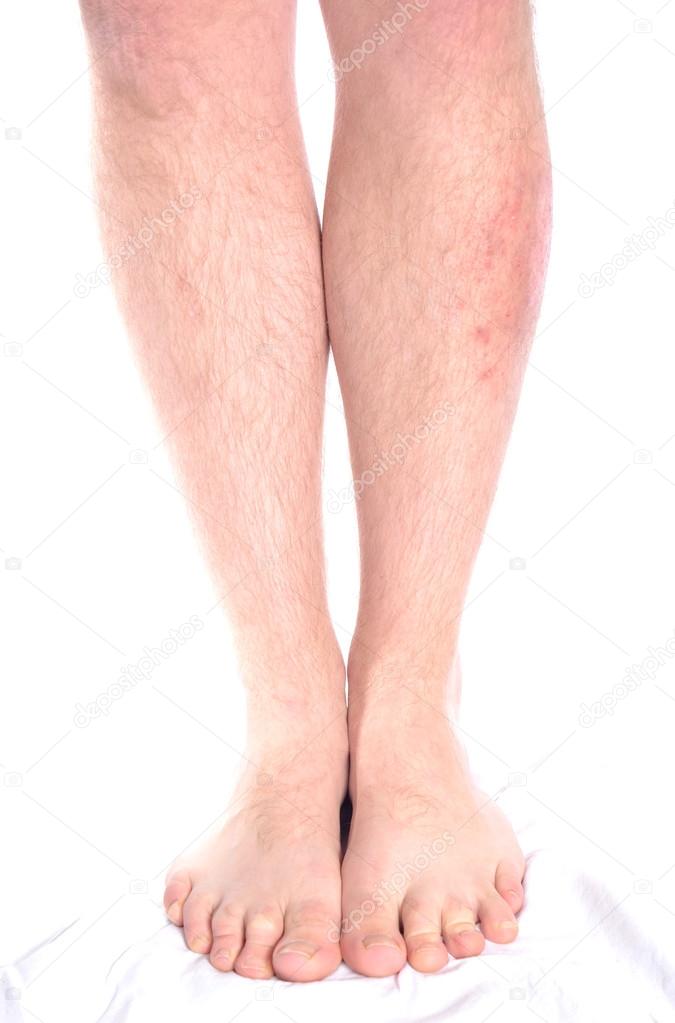 Skin Disease — Stock Photo © LaCameraChiara #21688425