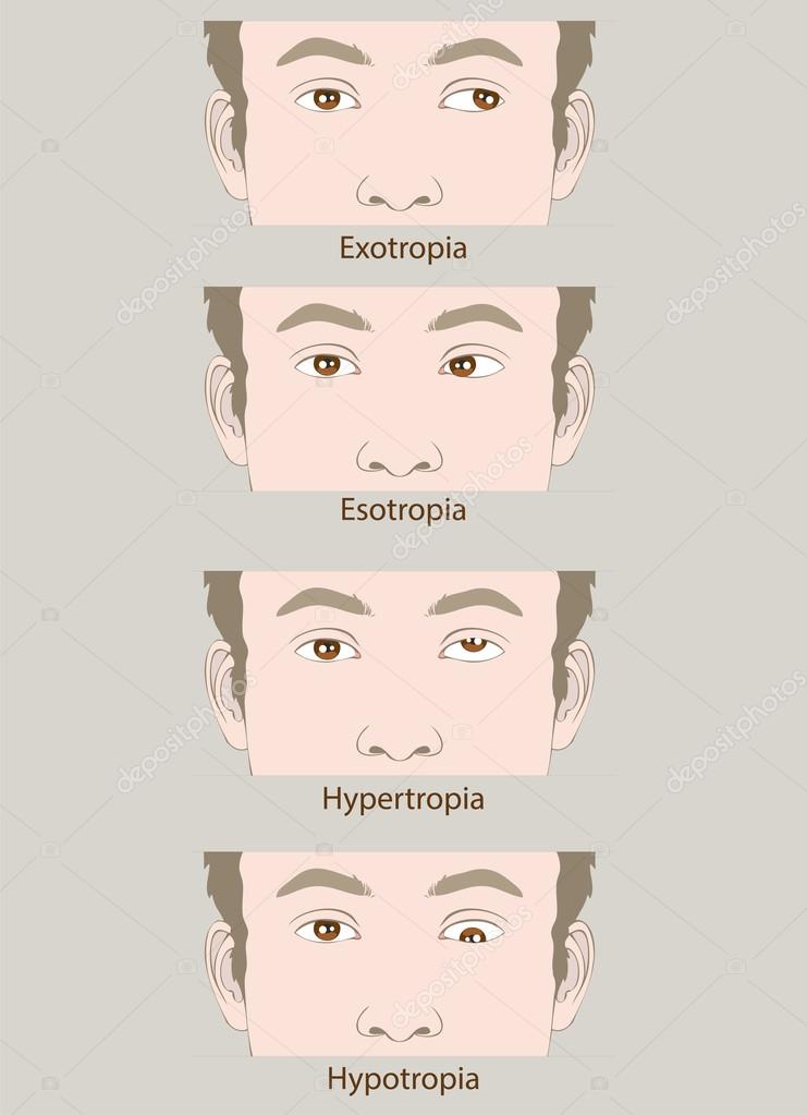 Defecto del estrabismo Esotropía, Exotropía, Hipertropía, Hipotropía ...