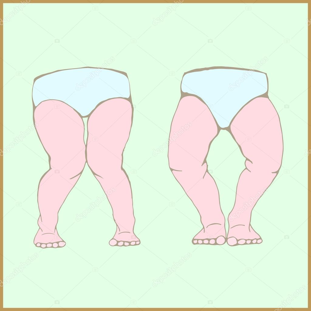 Genu Varum Genu Valgum A Physical Legs Deformity — Stock Vector © Eveleen 28109525