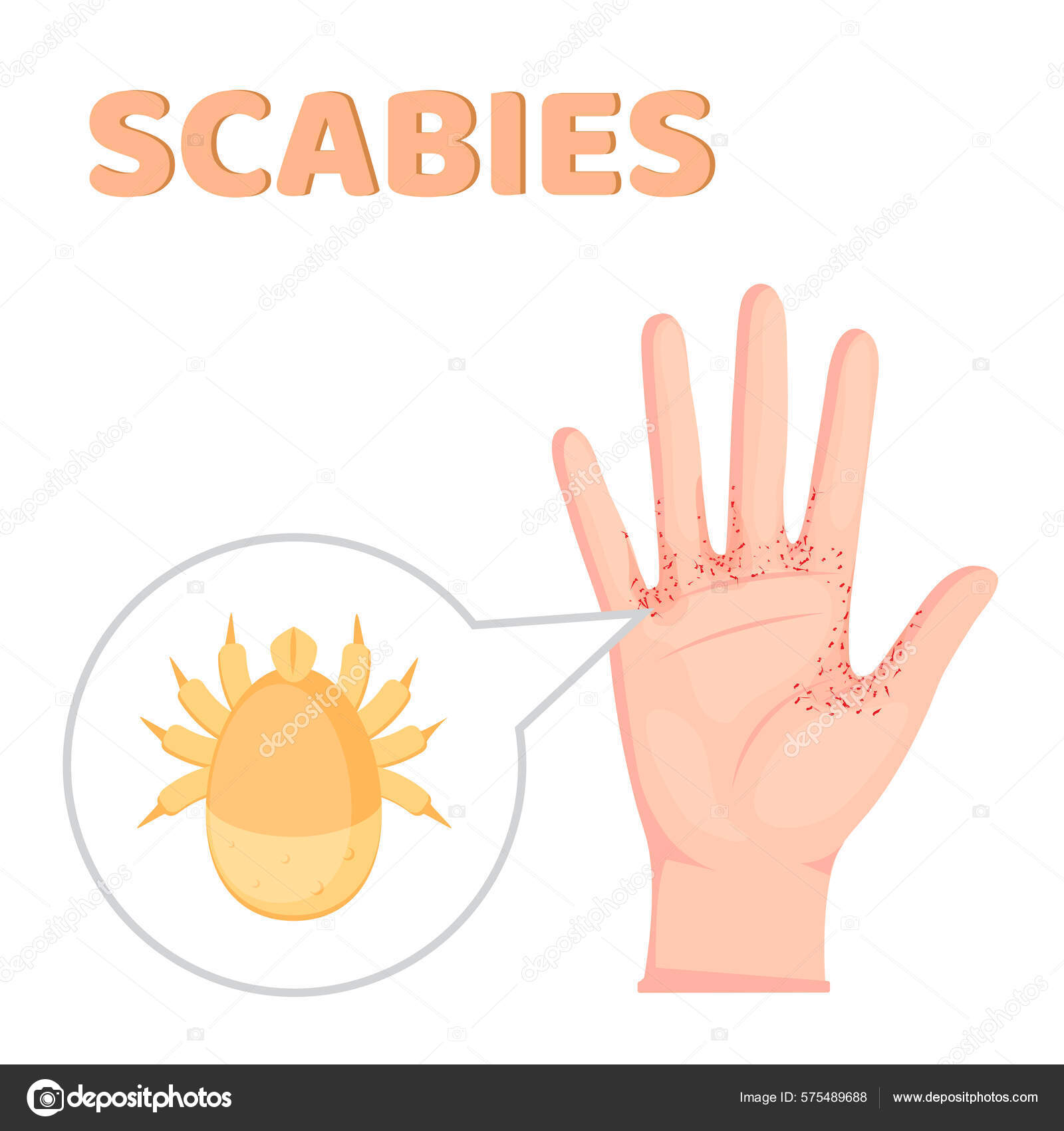Scabies Contagious Skin Infestation Scabies Mite Humans Skin Magnified ...