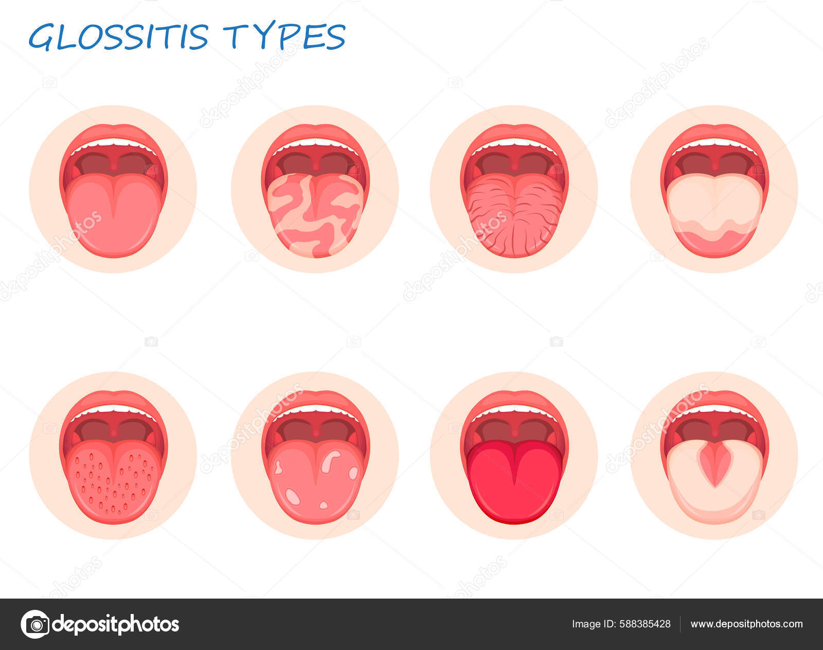 Types Glossitis Candidiasis Tongue Thrush Inflammation Tongue ...