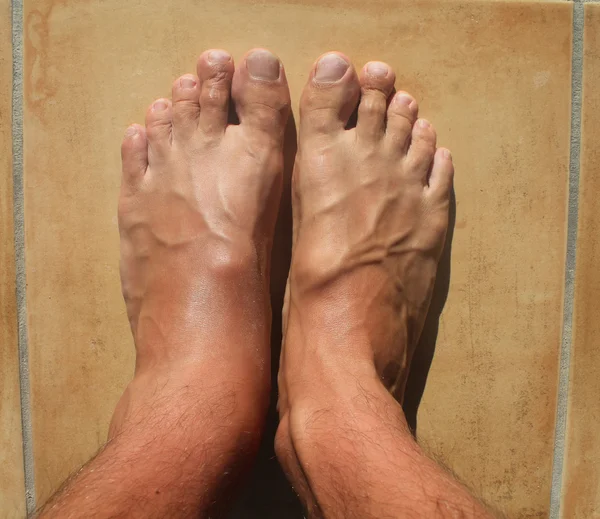 Broken ankle, mens feet - Stock Image - Everypixel