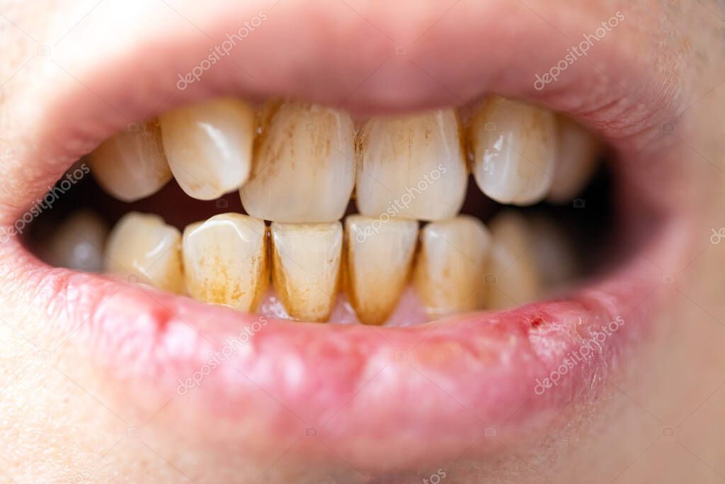 Dientes con mucho sarro y placa. Concepto de dientes sucios poco ...