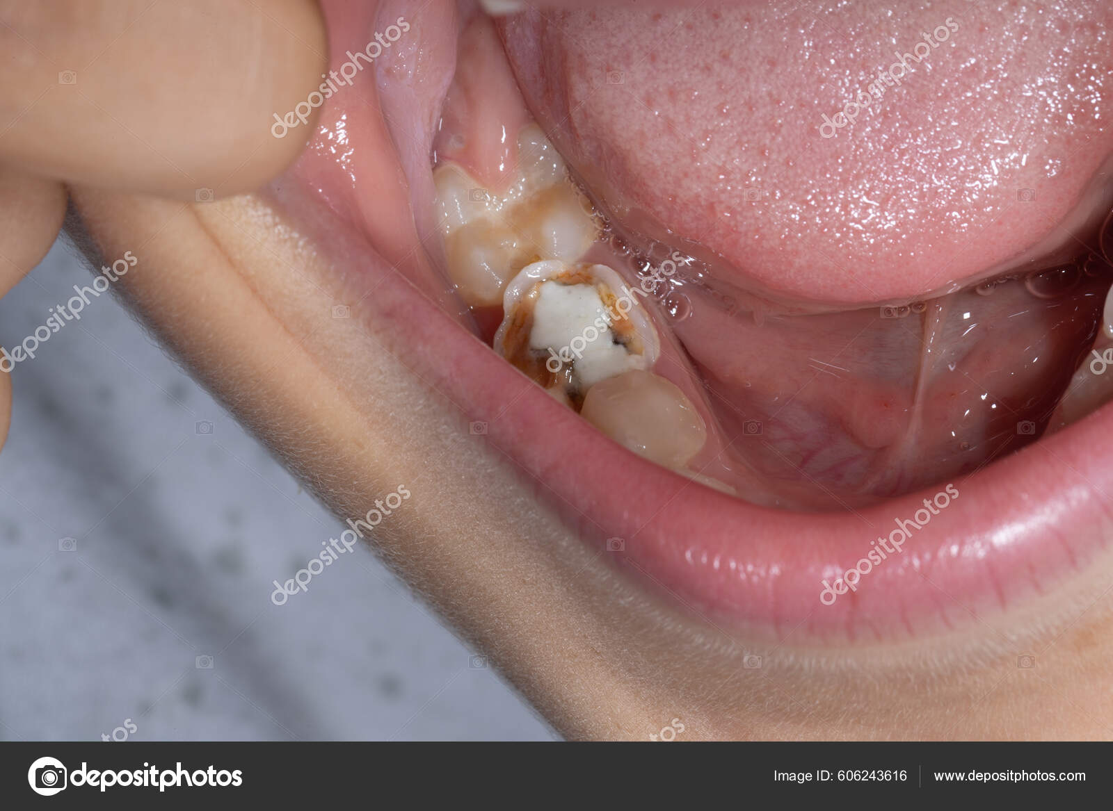 Hole Child's Tooth Destruction Tooth Dental Caries Disease — Stock ...