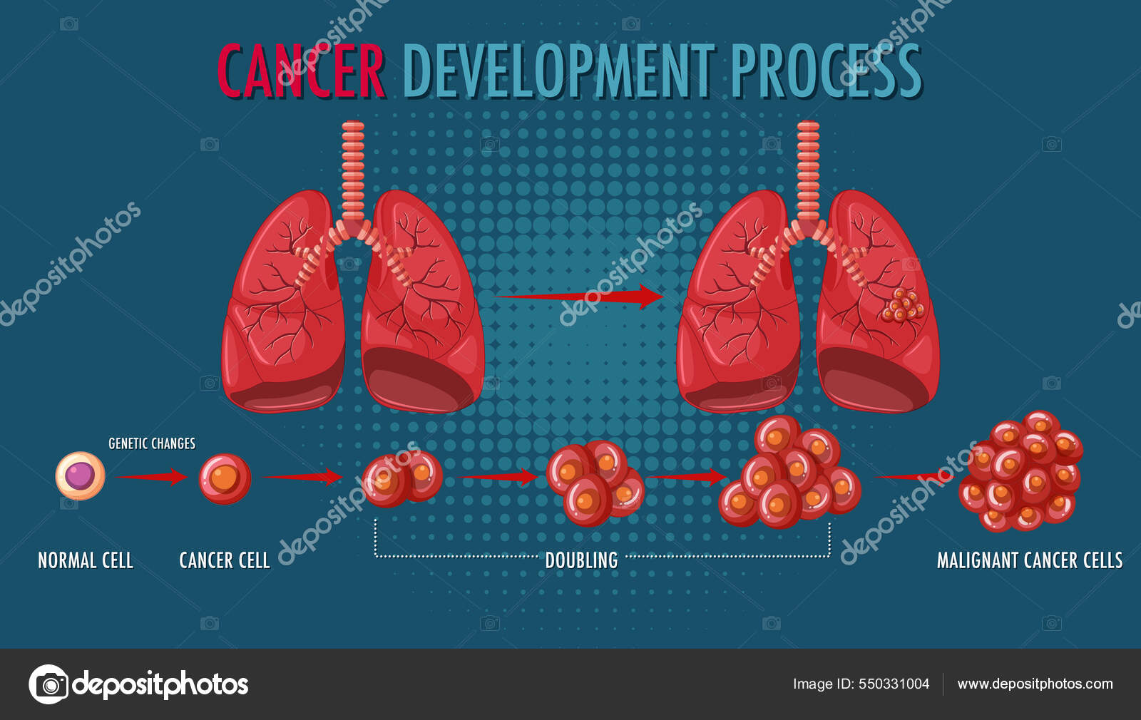 Proceso Desarrollo Del Cáncer Ilustración Infográfica vector, gráfico ...