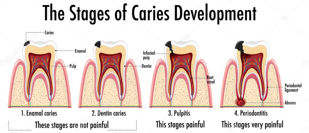 Infografía del ser humano en las etapas de desarrollo de la caries ...