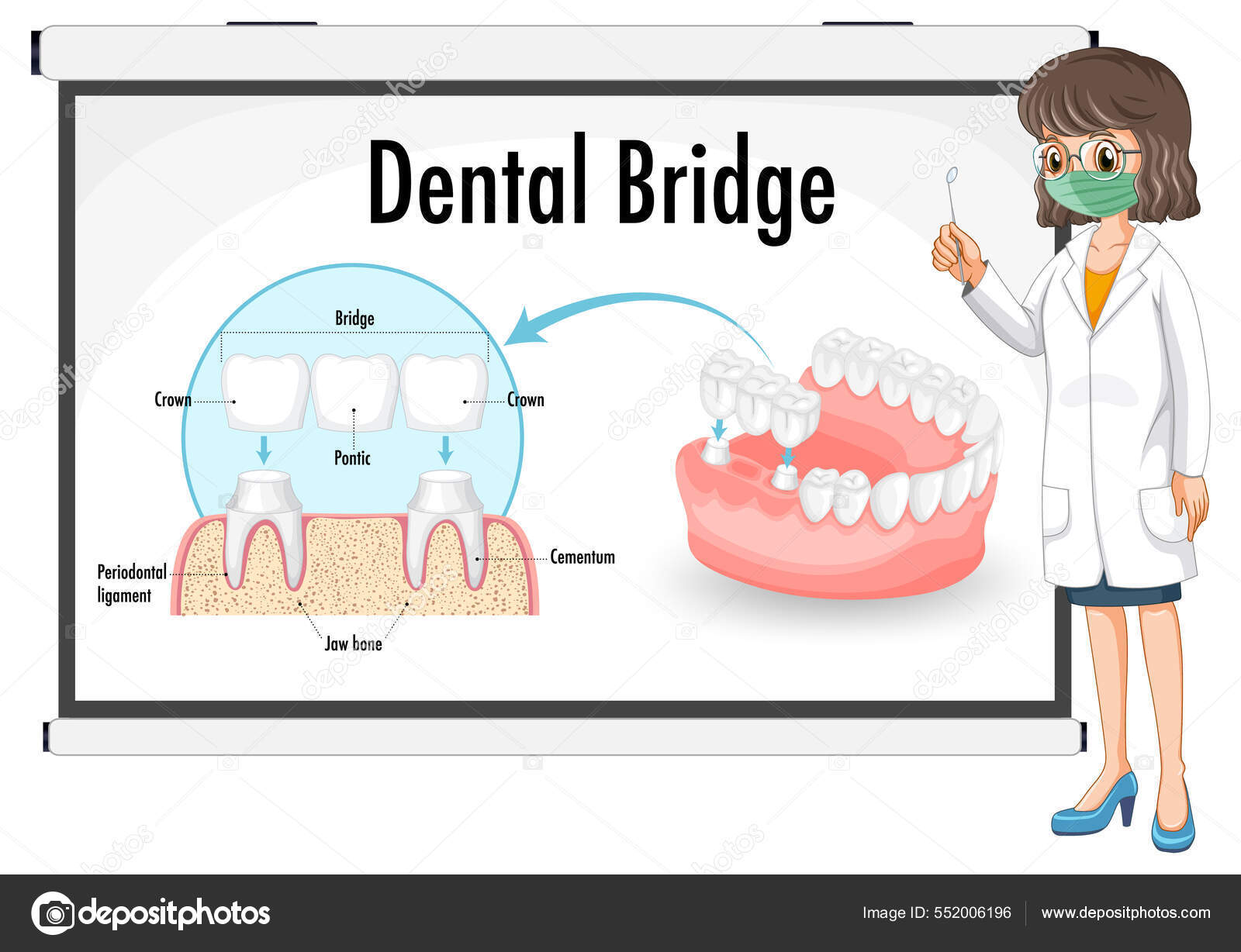 Infographic Human Dental Bridge White Background Illustration Stock ...