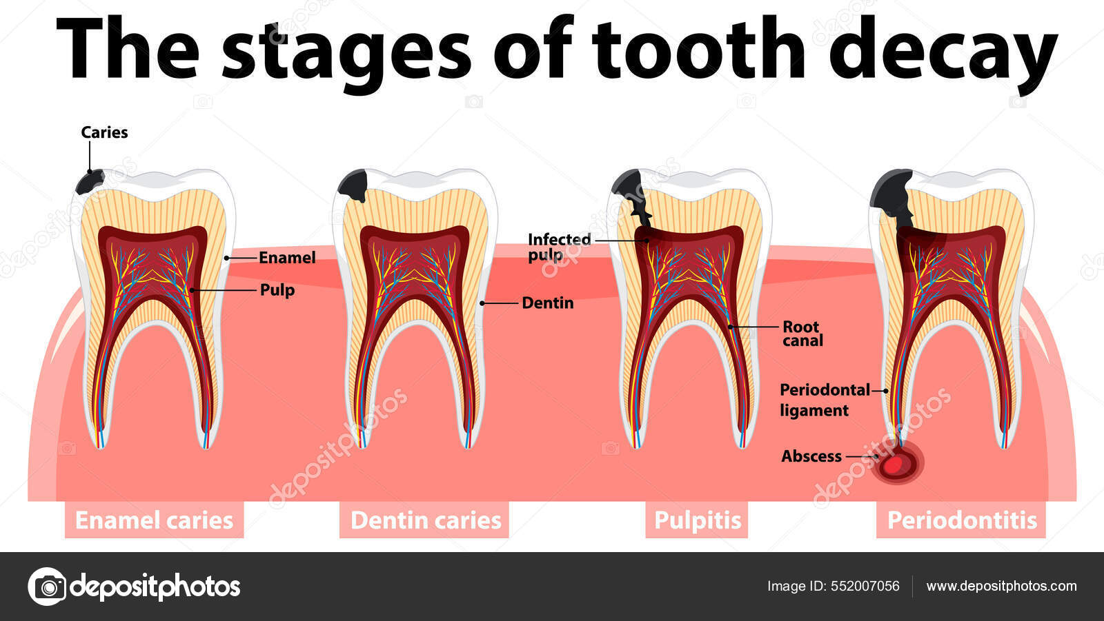 Infografía Del Ser Humano Las Etapas Caries Dental Ilustración Vector ...