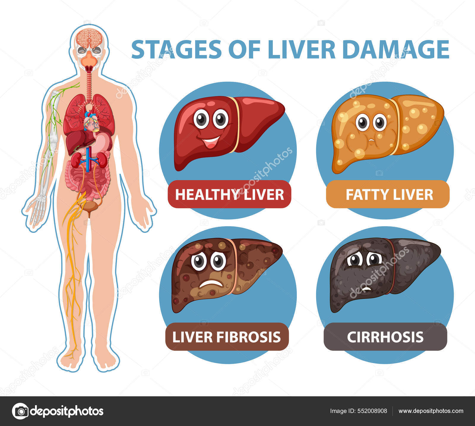Diagram Showing Stages Liver Damage Illustration Stock Vector Image by ... Diagram Showing Stages Liver Damage Illustration Stock Vector Image by ...